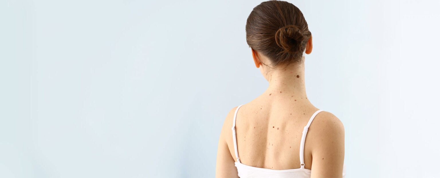 Best Practices for Self-Skin Checks: Monitor Your Skin Health