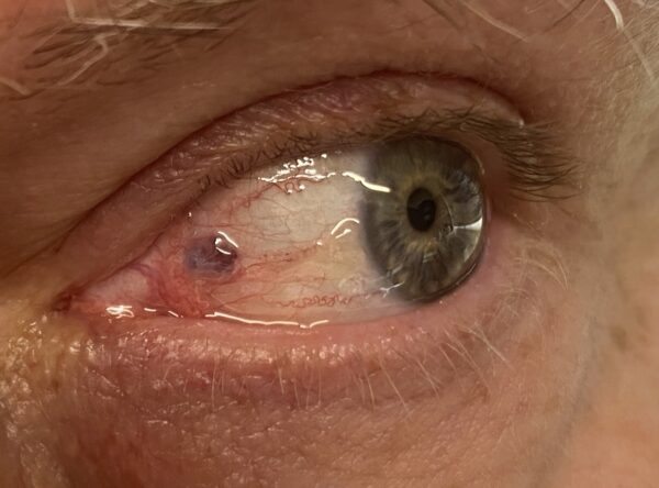 Eye Cancer Screening: Key Dermatoscopic Features Explained