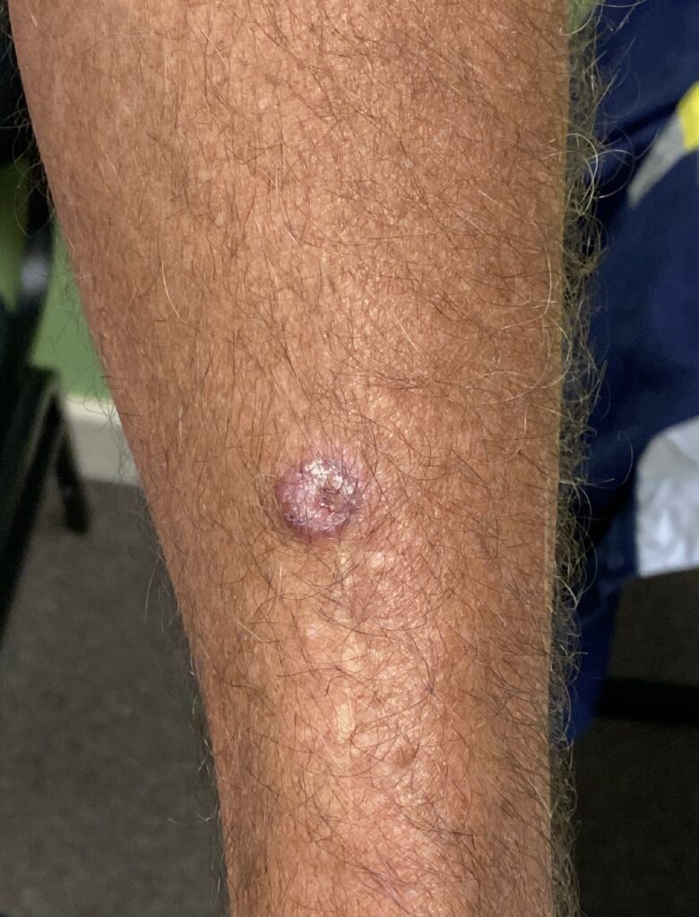 Skin Cancer on Arms | Sun Damage in Western Australia